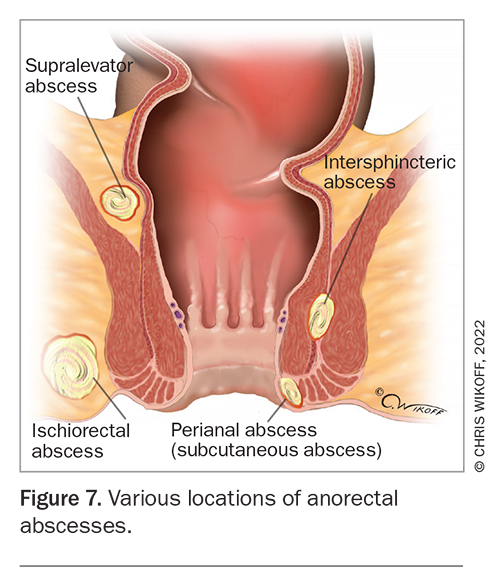 Perirectal Abscess Vs Perianal Abscess